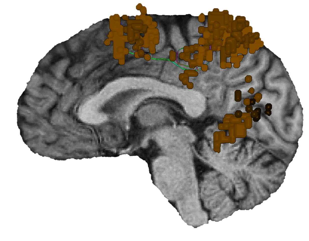 The Dorsal Attention Network