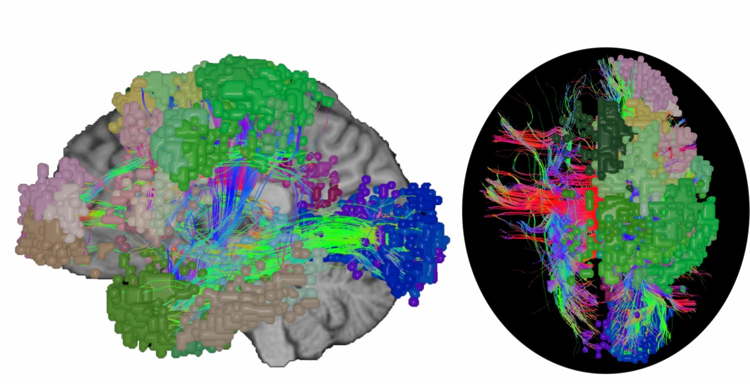 Connectomics & Epilepsy