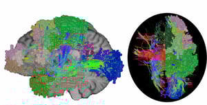 Connectomics & Epilepsy