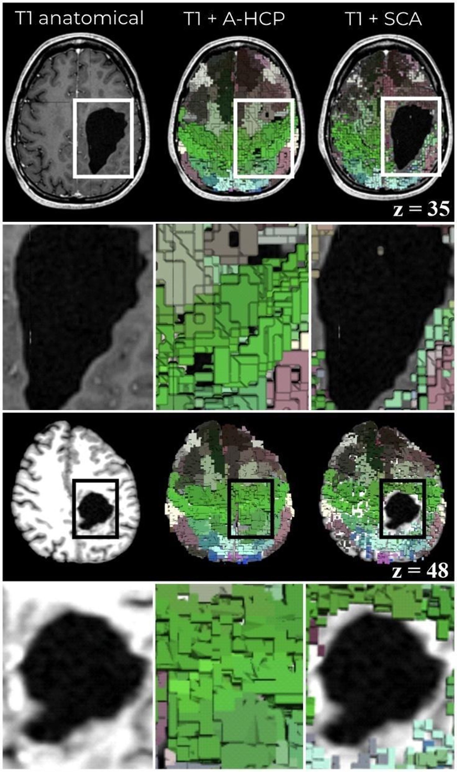 How Personalized Mapping of Brain Networks aids Neurosurgery
