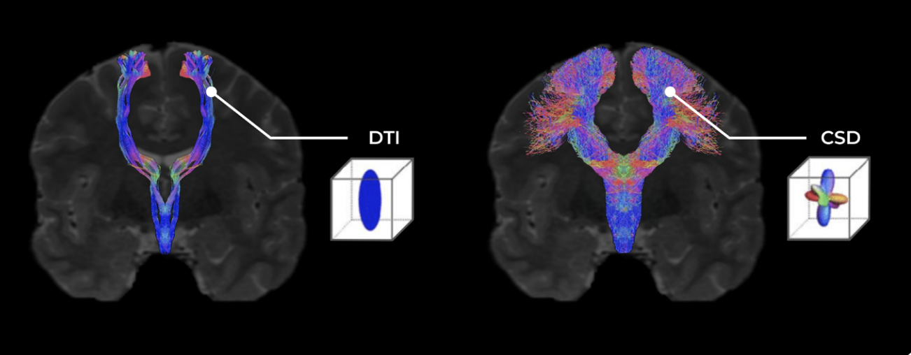 What is tractography?