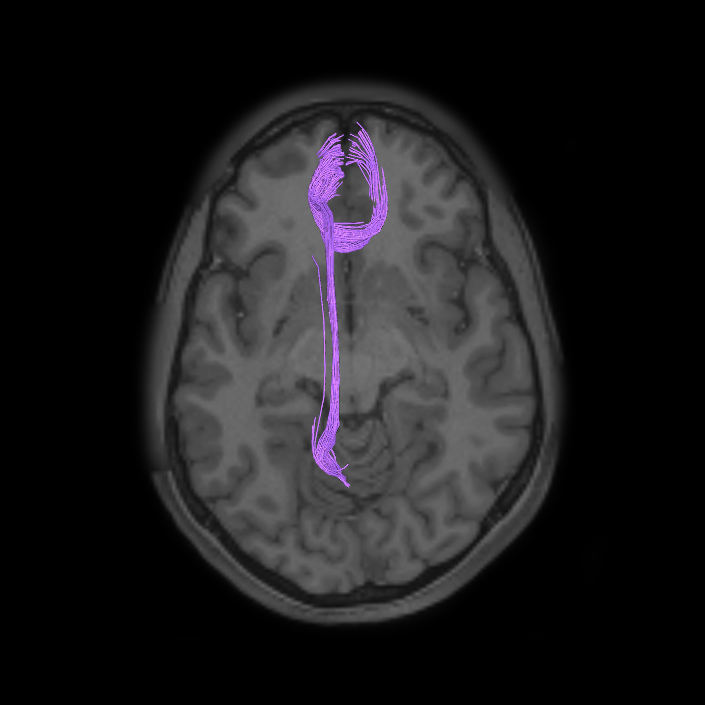 Default Mode Network - Connectome Guide