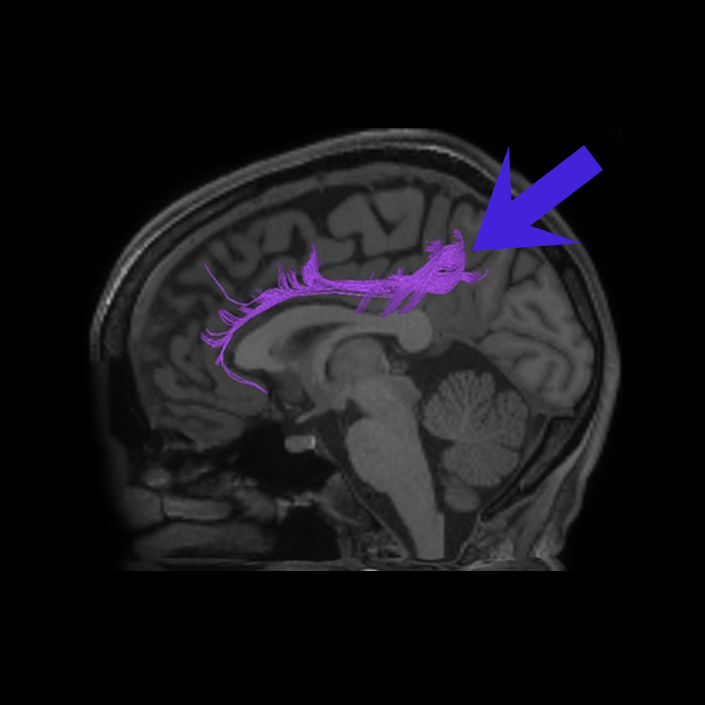 Default Mode Network - Connectome Guide