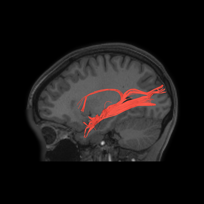 Accessory Language Network - Connectome Guide