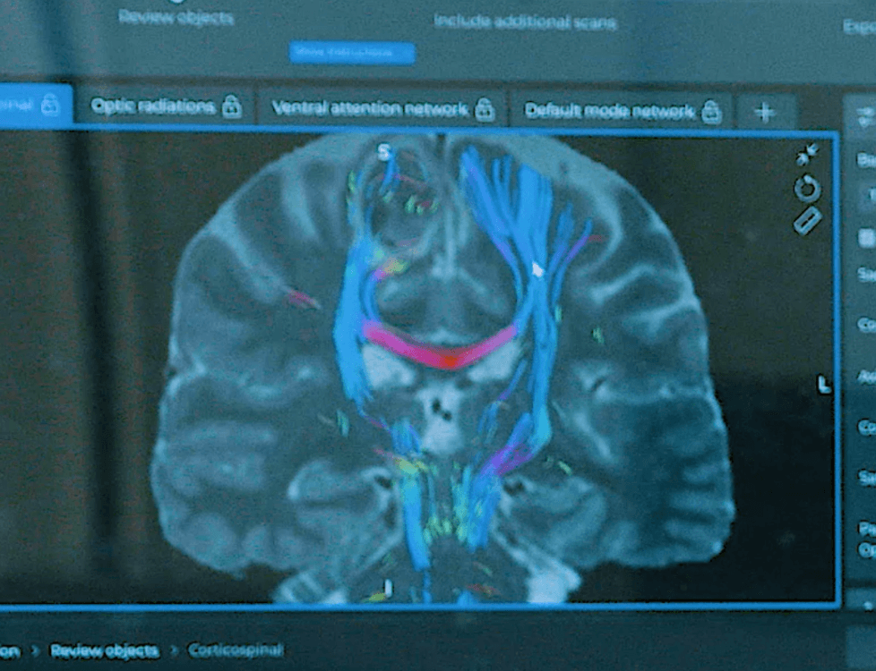Preserving the corticospinal tract