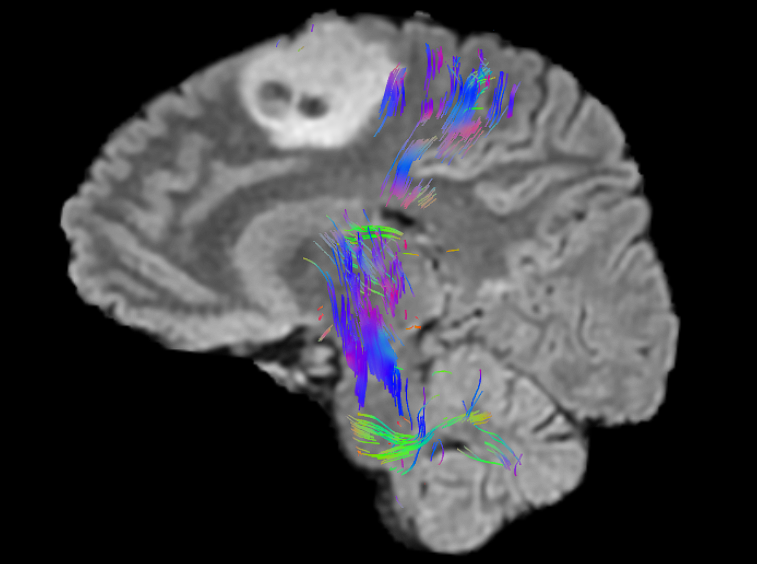 Left frontal lobe glioma and the frontal aslant tract