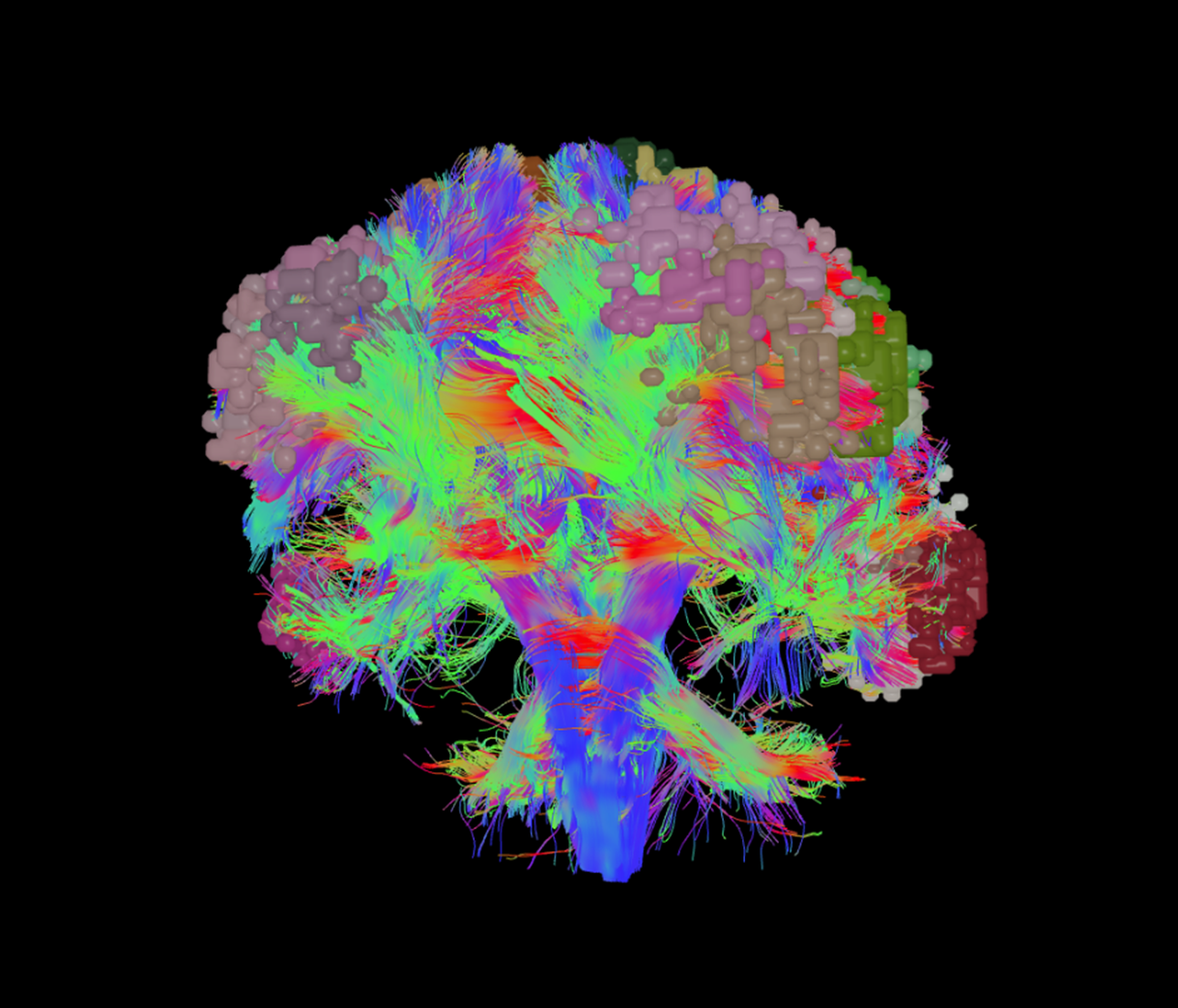 How Personalized Mapping of Brain Networks aids Neurosurgery
